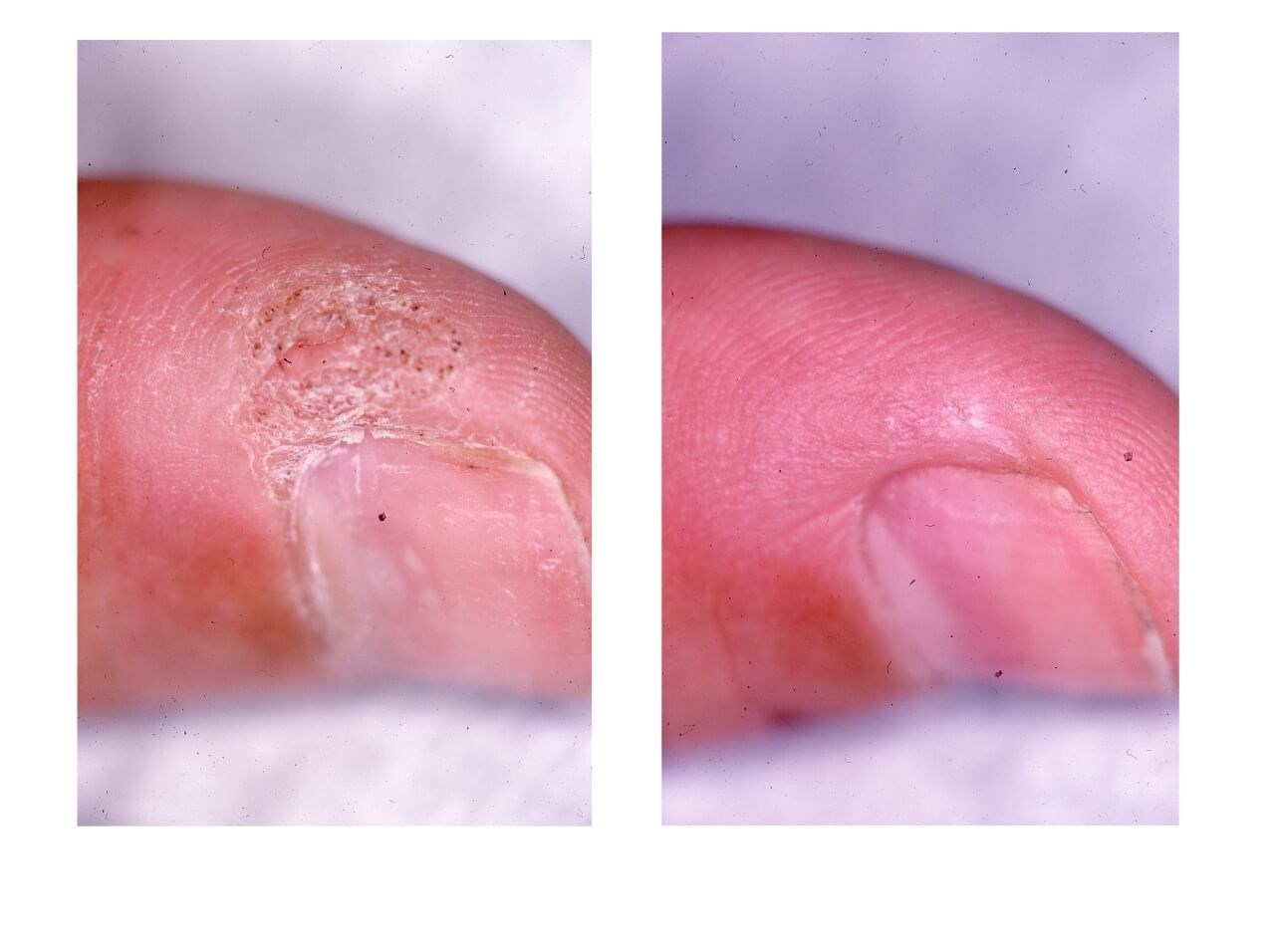 Warts Before & After Photos | Bodian Dermatology