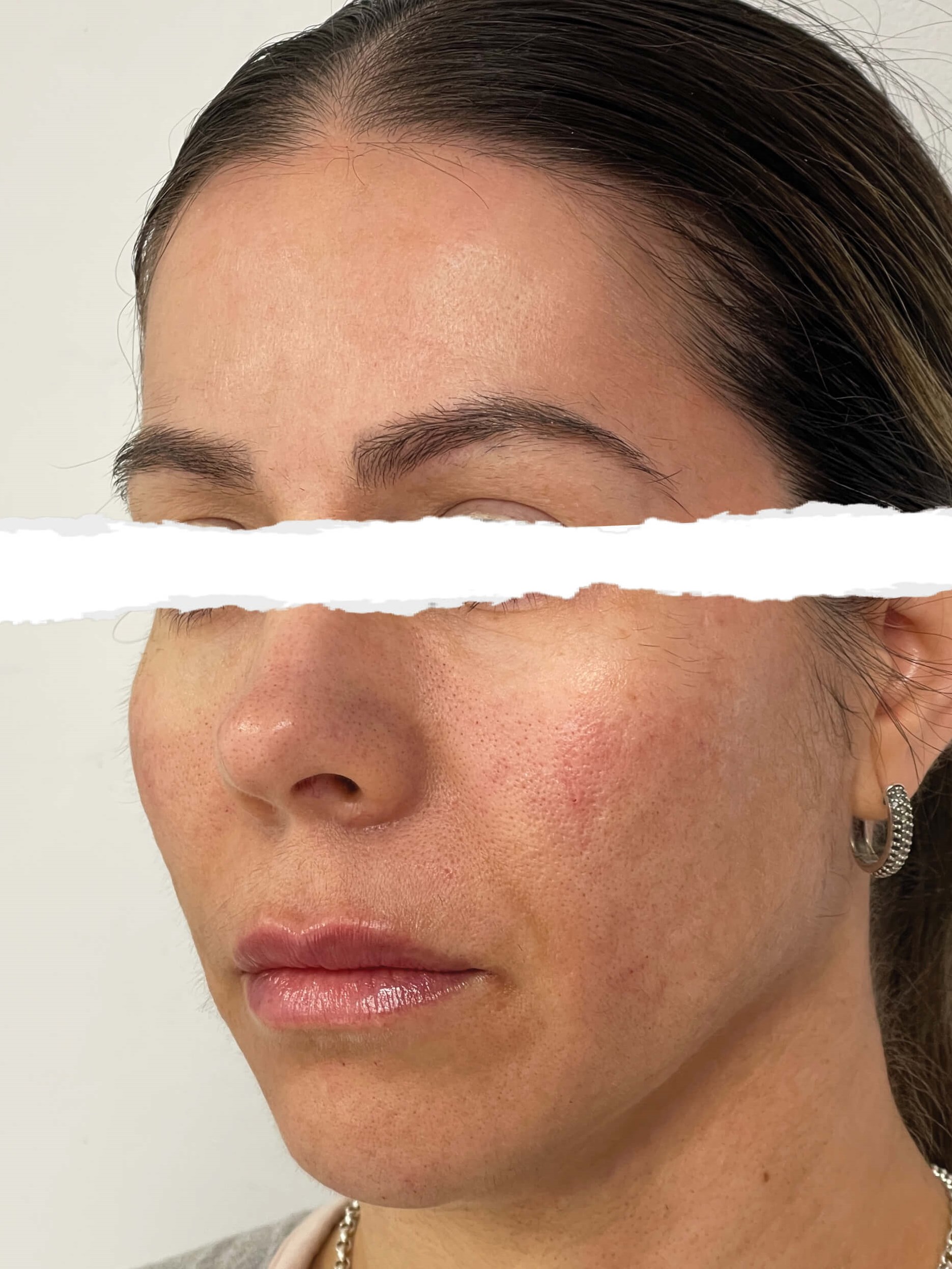 Full Face Rejuvenation