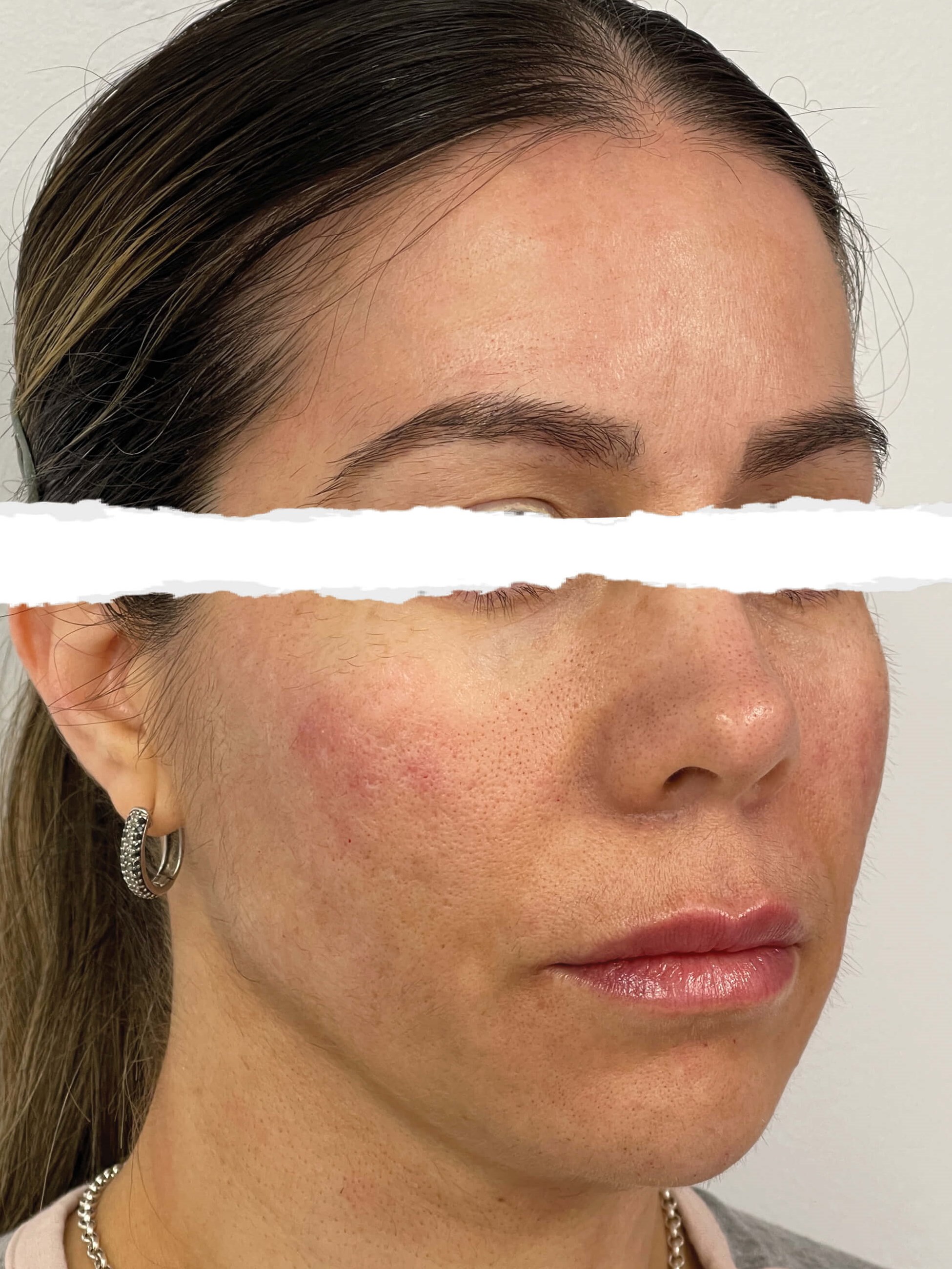 Full Face Rejuvenation