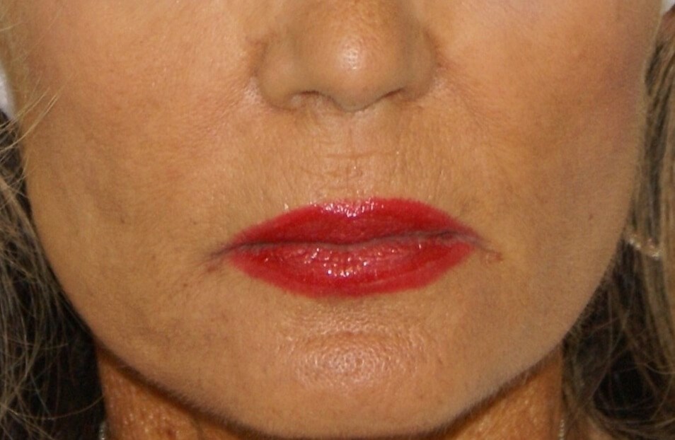 Causes Of Hollow Cheeks – Sunken Cheeks: Causes, Treatment, and ...