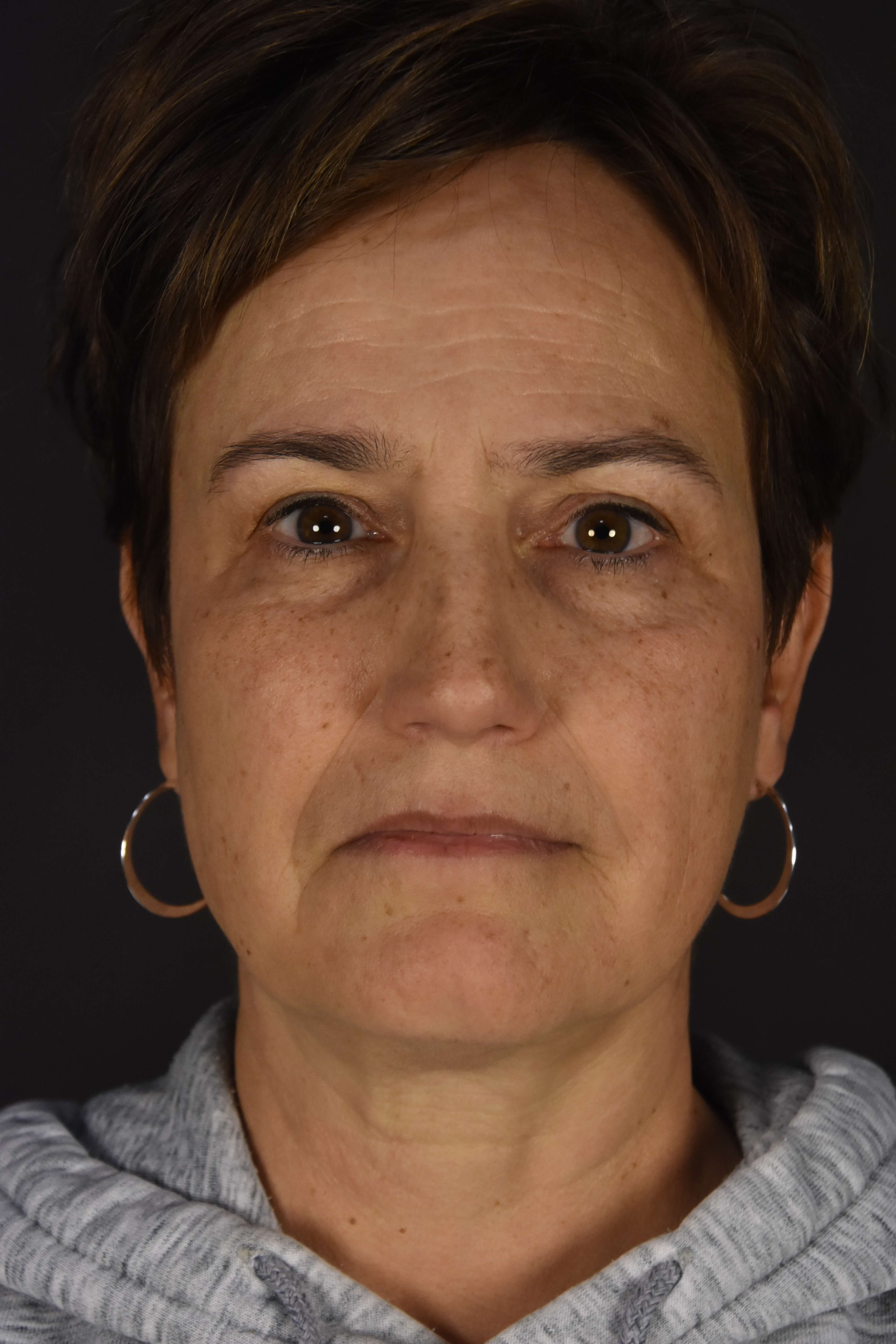 Lower eyelids with browlift