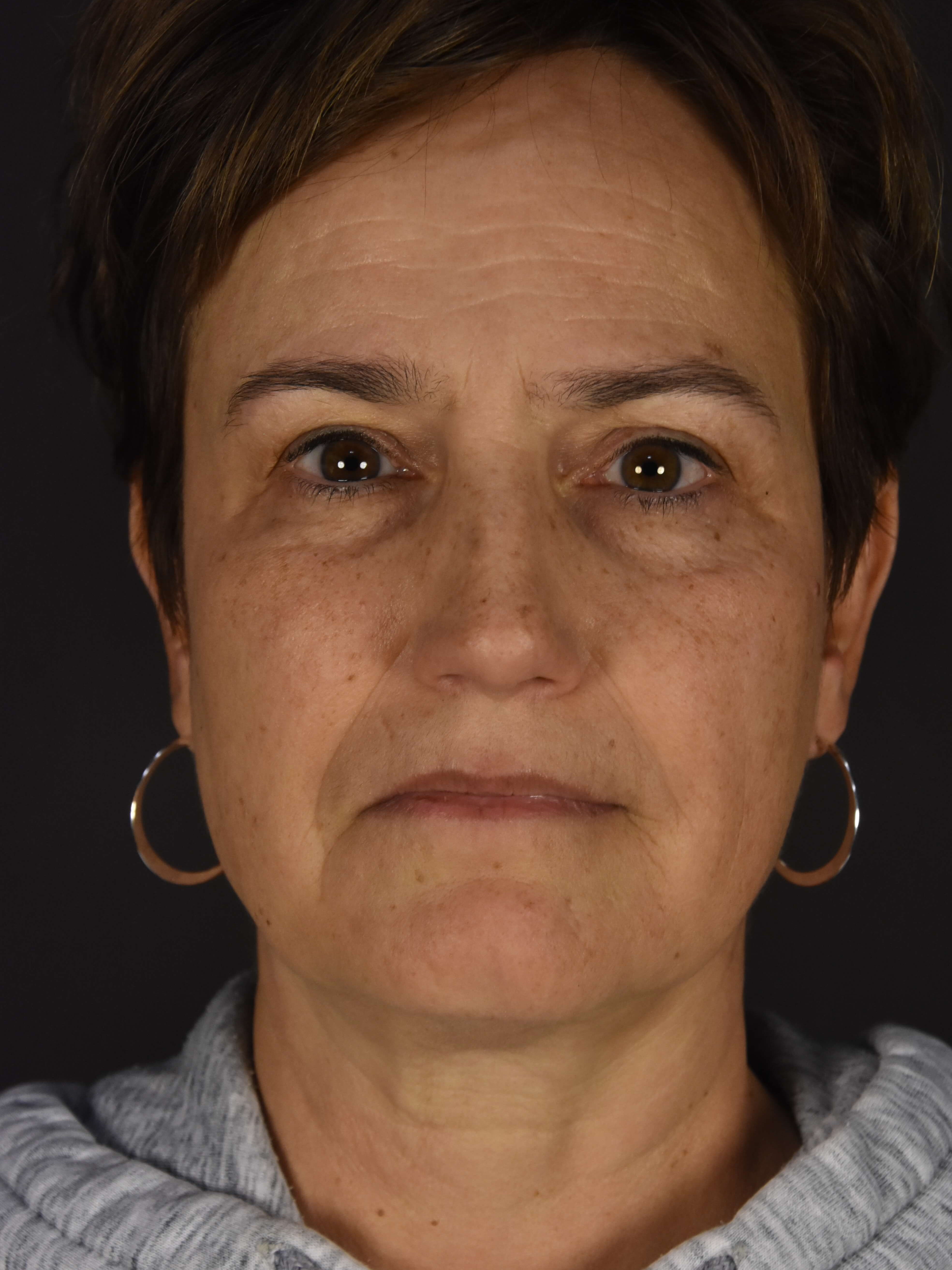 Lower eyelids with browlift