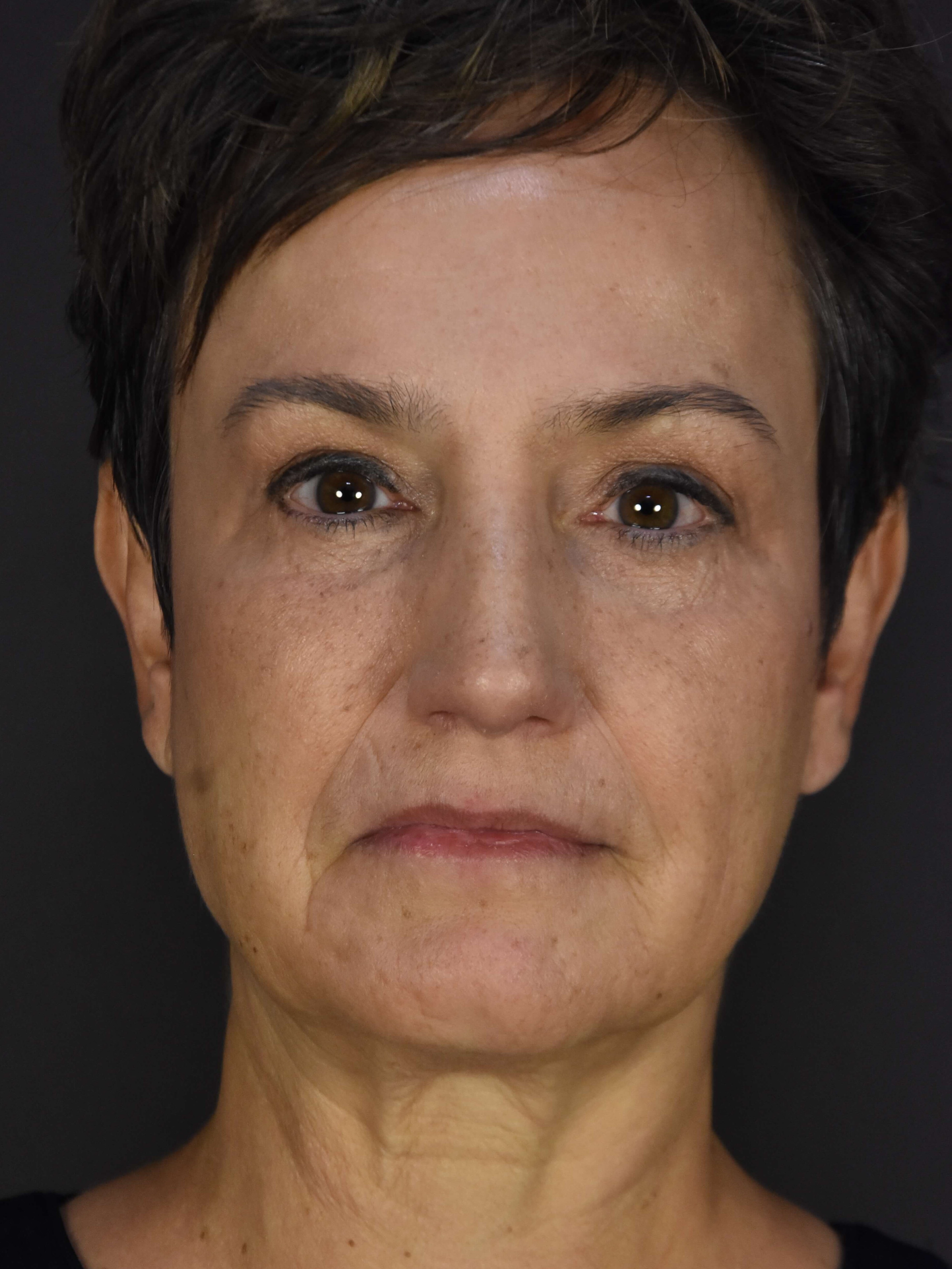 Lower eyelids with browlift
