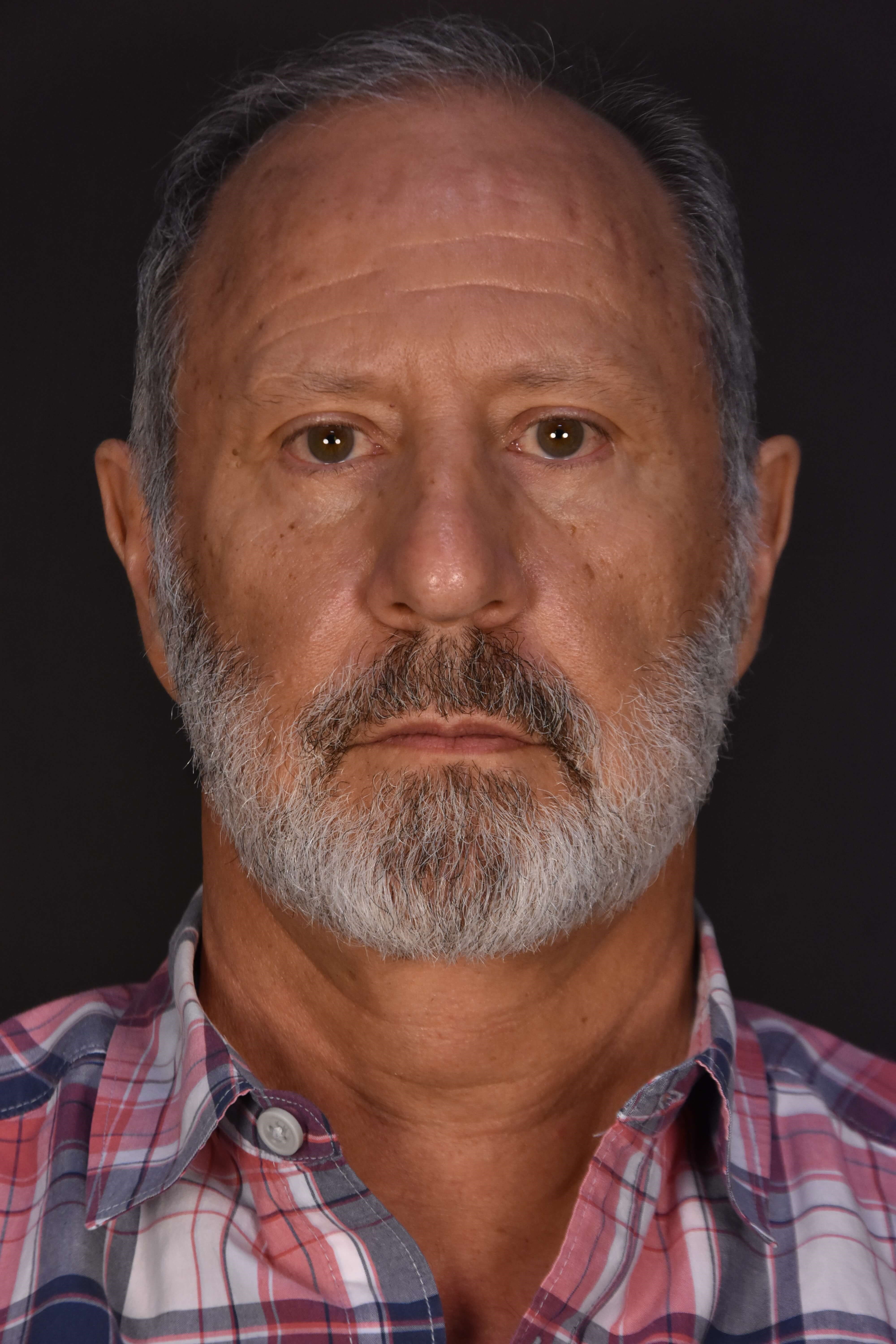 Lower eyelids and necklift with Dr. Higgins
