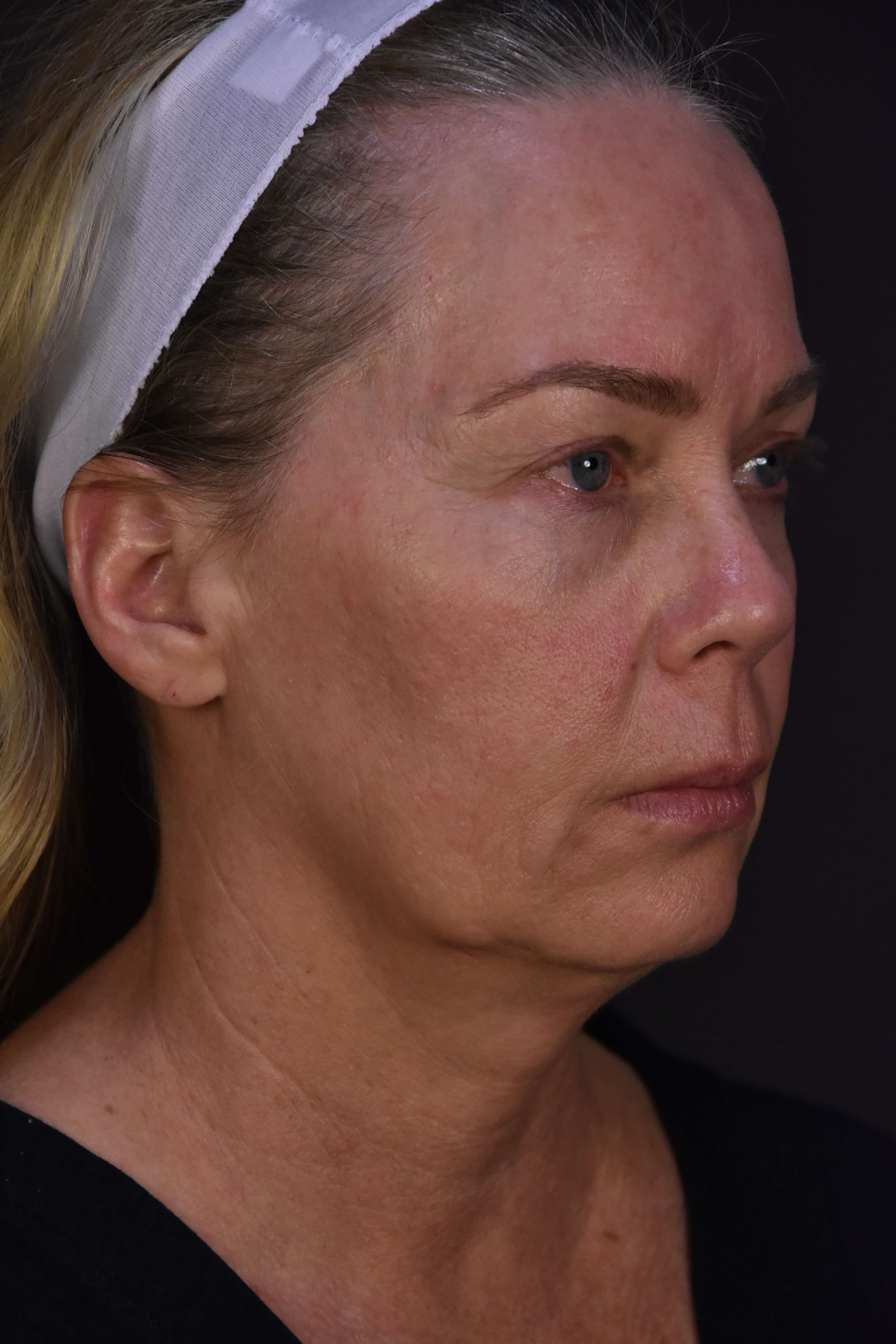 Browlift, Eyelids, Fat injection and lip lift