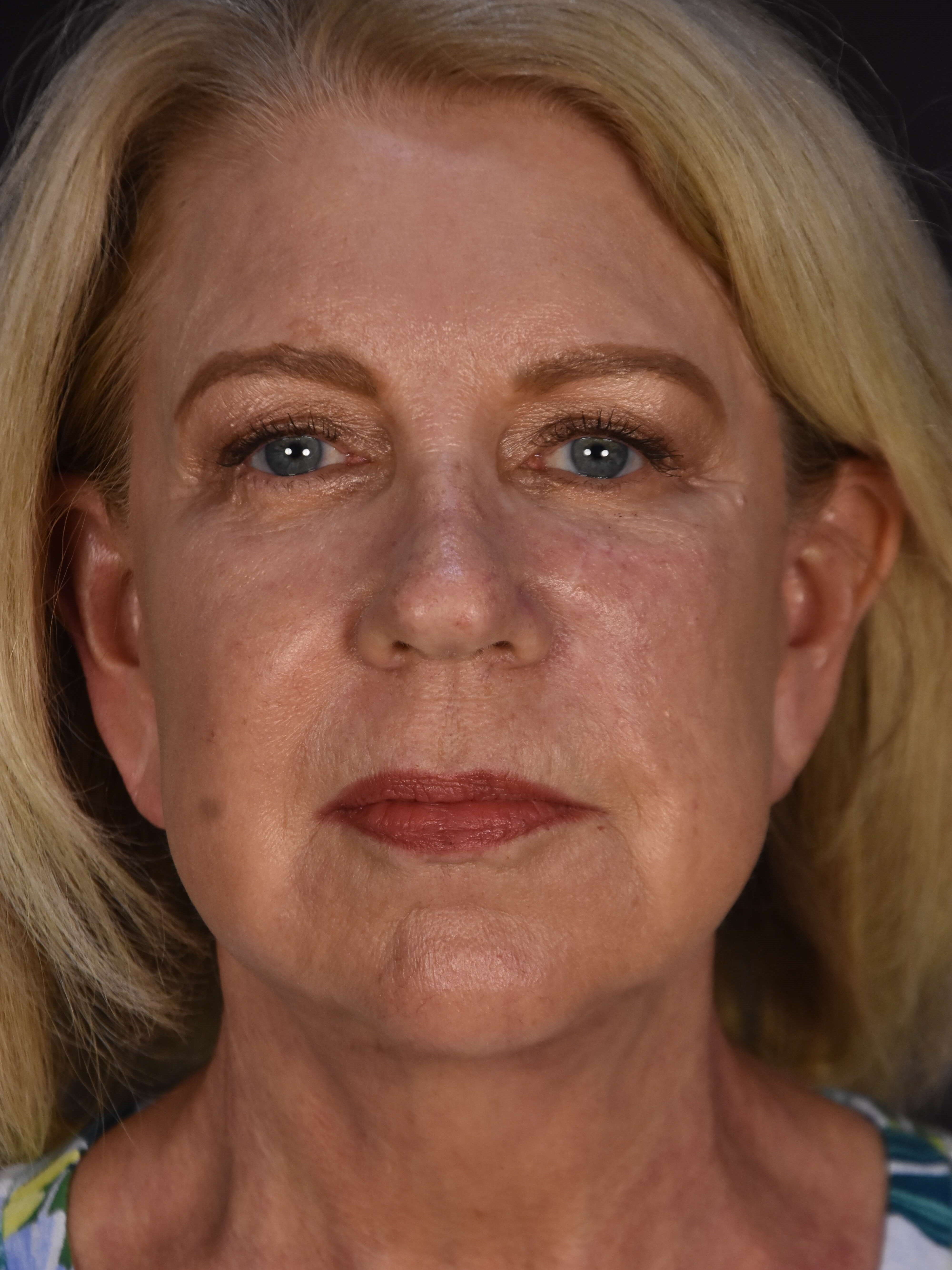 Patient of Dr. Higgins receives Brow Lift, Facelift, and Blepharoplasty