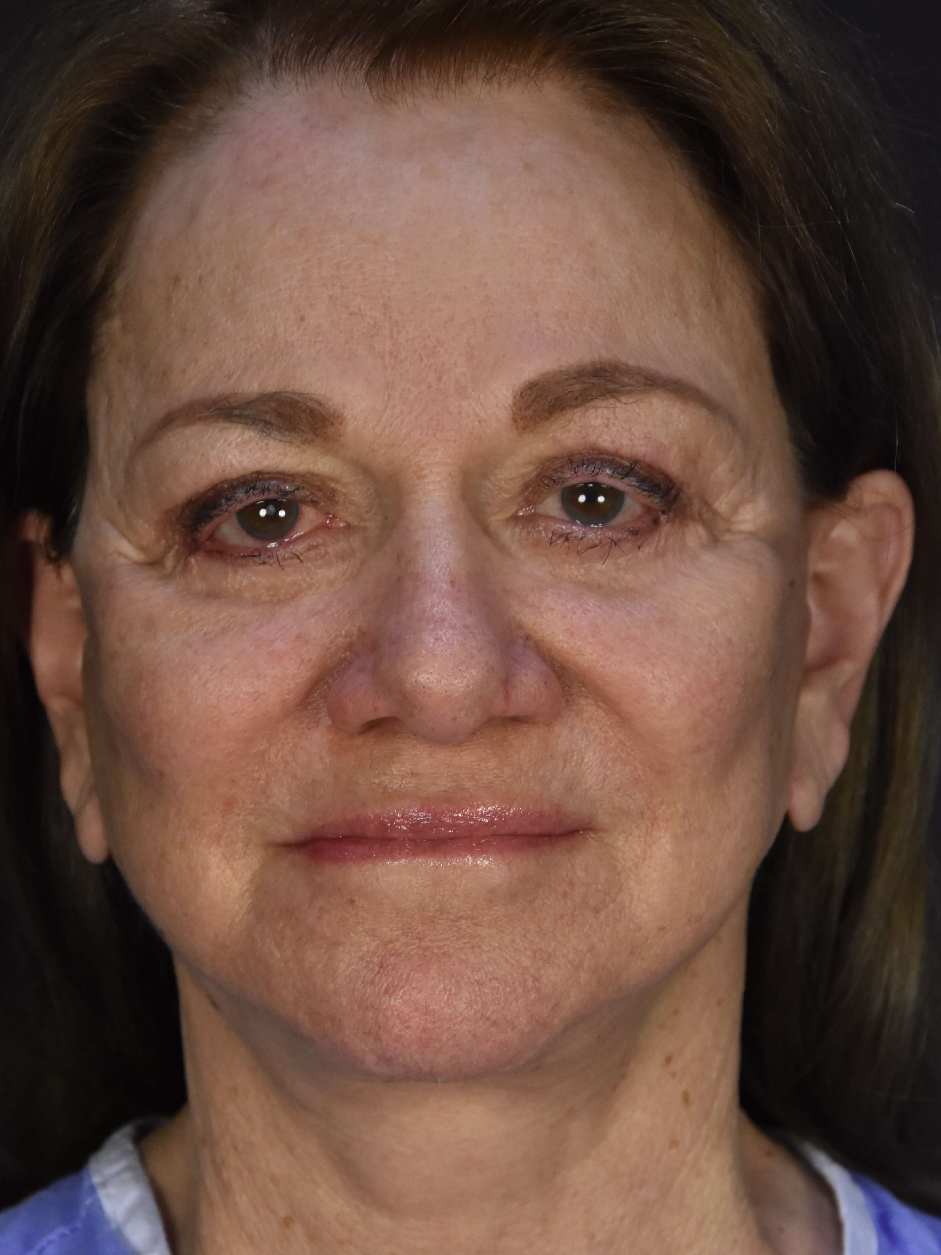 Patient had a Facelift, Blepharoplasty, Brow Lift, Fat Transfer with Dr ...