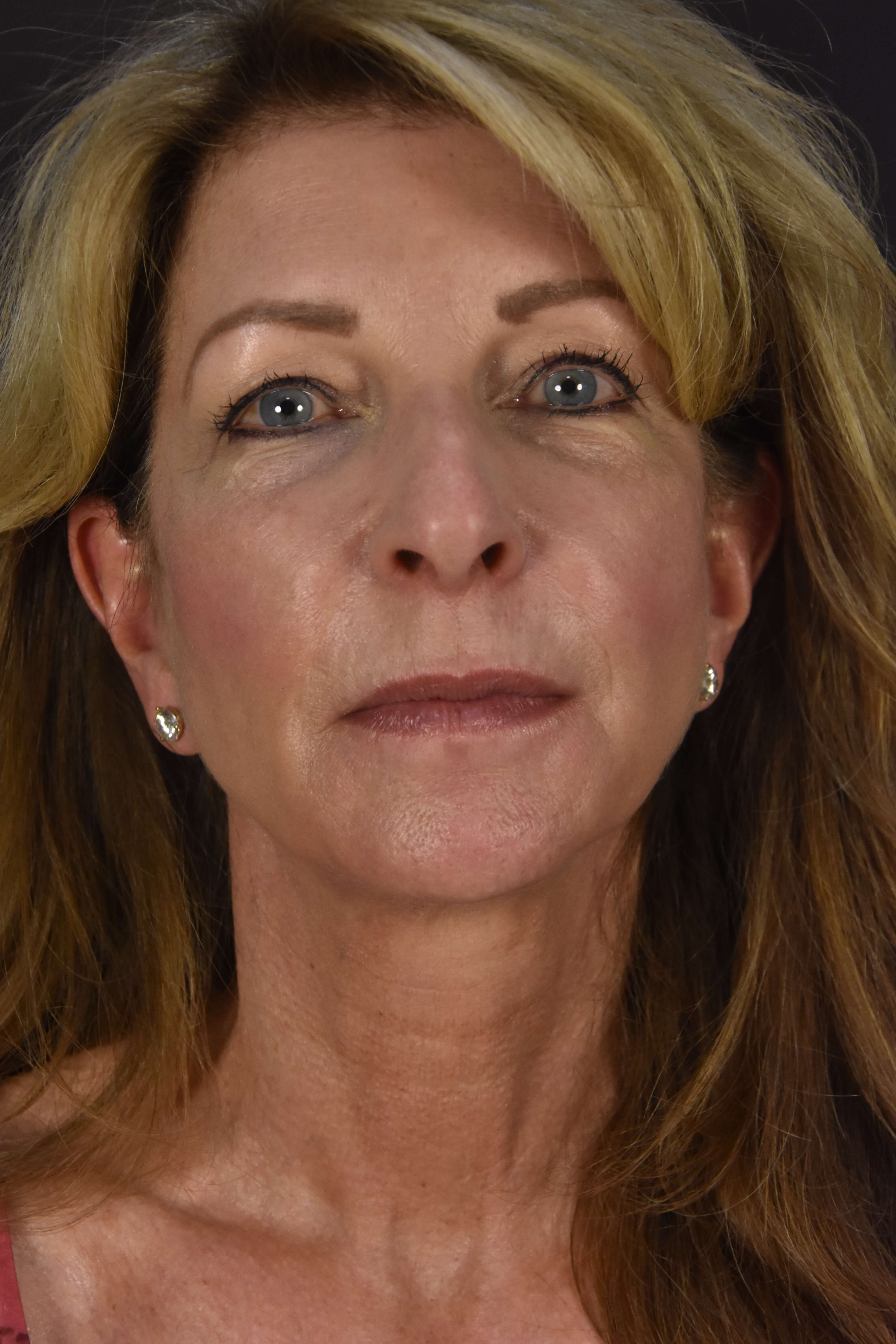 64 year old beautiful Facelift results!