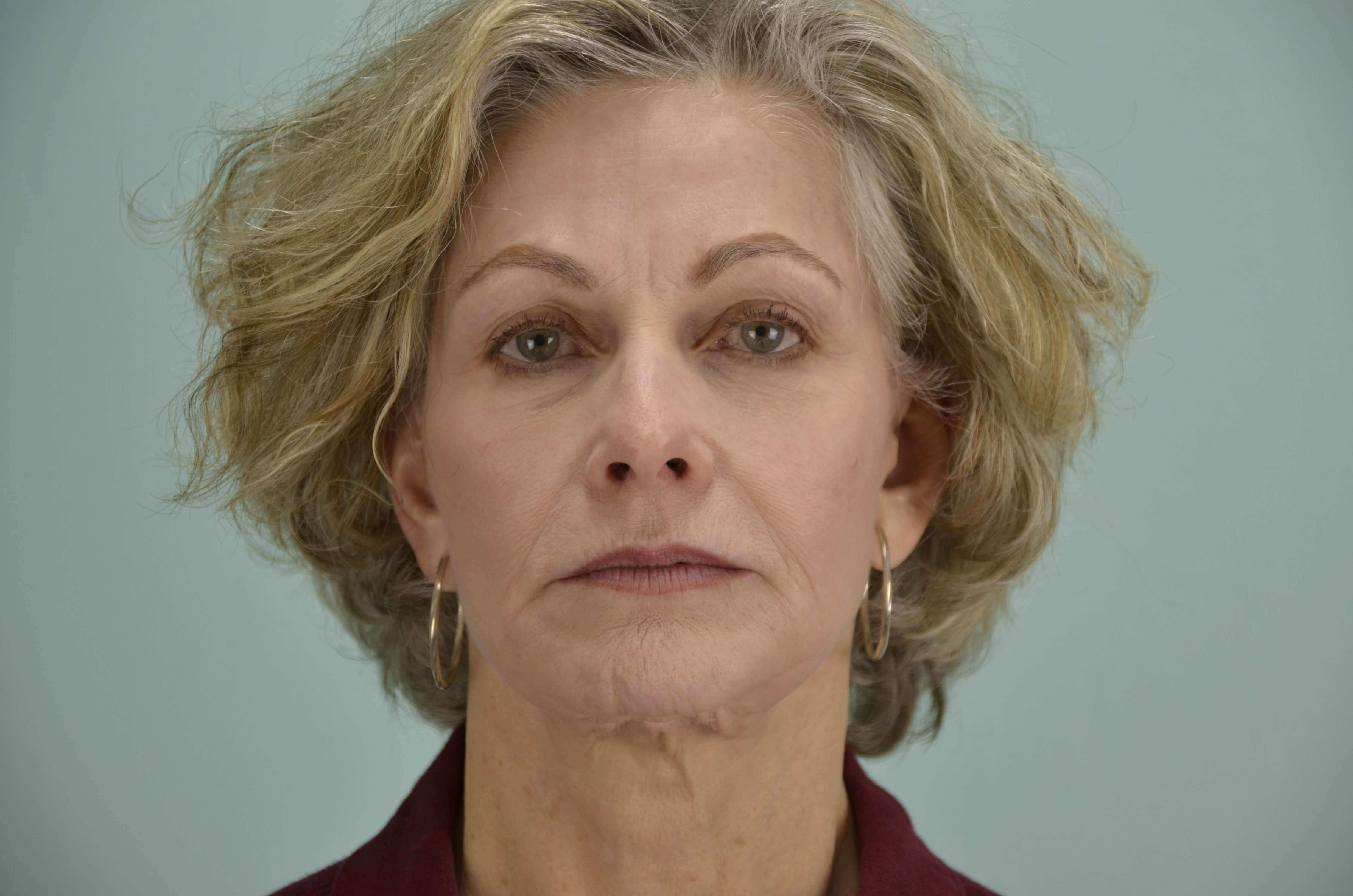 70s Female Facelift Results After Failed Previous Facelifts Dallas TX 70s Female Facelift Results After Failed Previous Facelifts Dallas TX